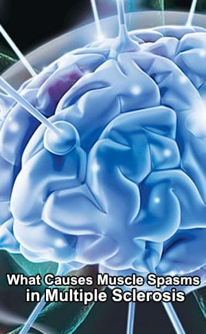 What Causes Muscle Spasms in Multiple Sclerosis - RespectCareGivers