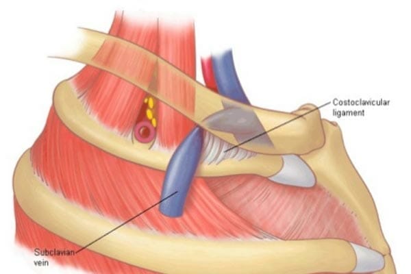 What is Costoclavicular Syndrome? - RespectCareGivers