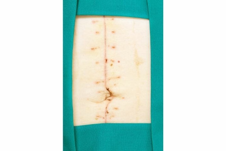 Do BBL Scars Go Away? - RespectCareGivers