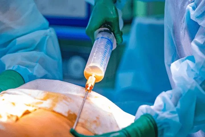 What Is Lipo 360 BBL - RespectCareGivers